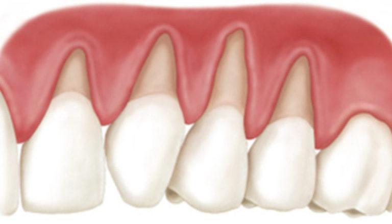 Récession gingivale - 26 Victor Hugo