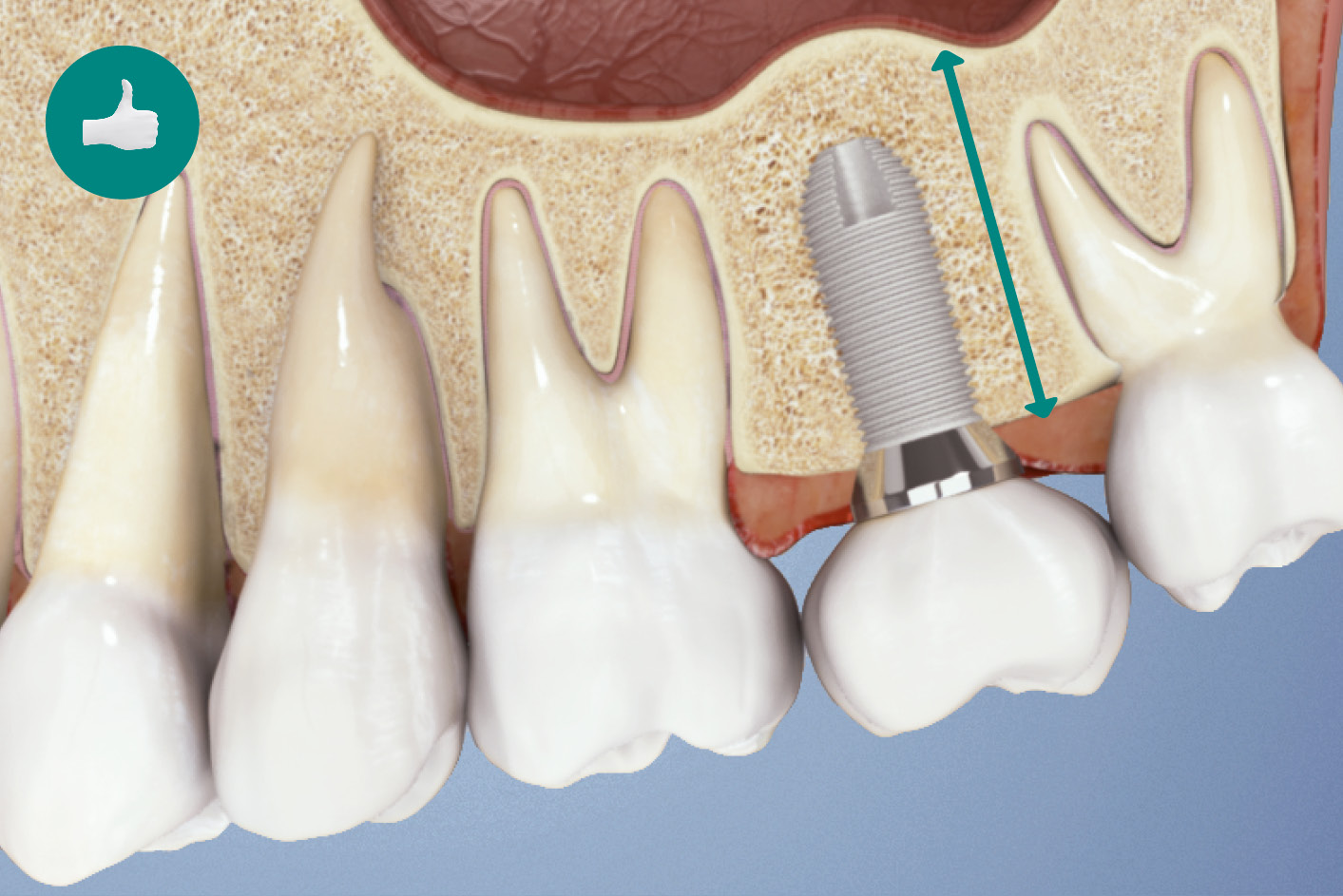 Implantologie Reconstruction Osseuse - 26 Victor Hugo